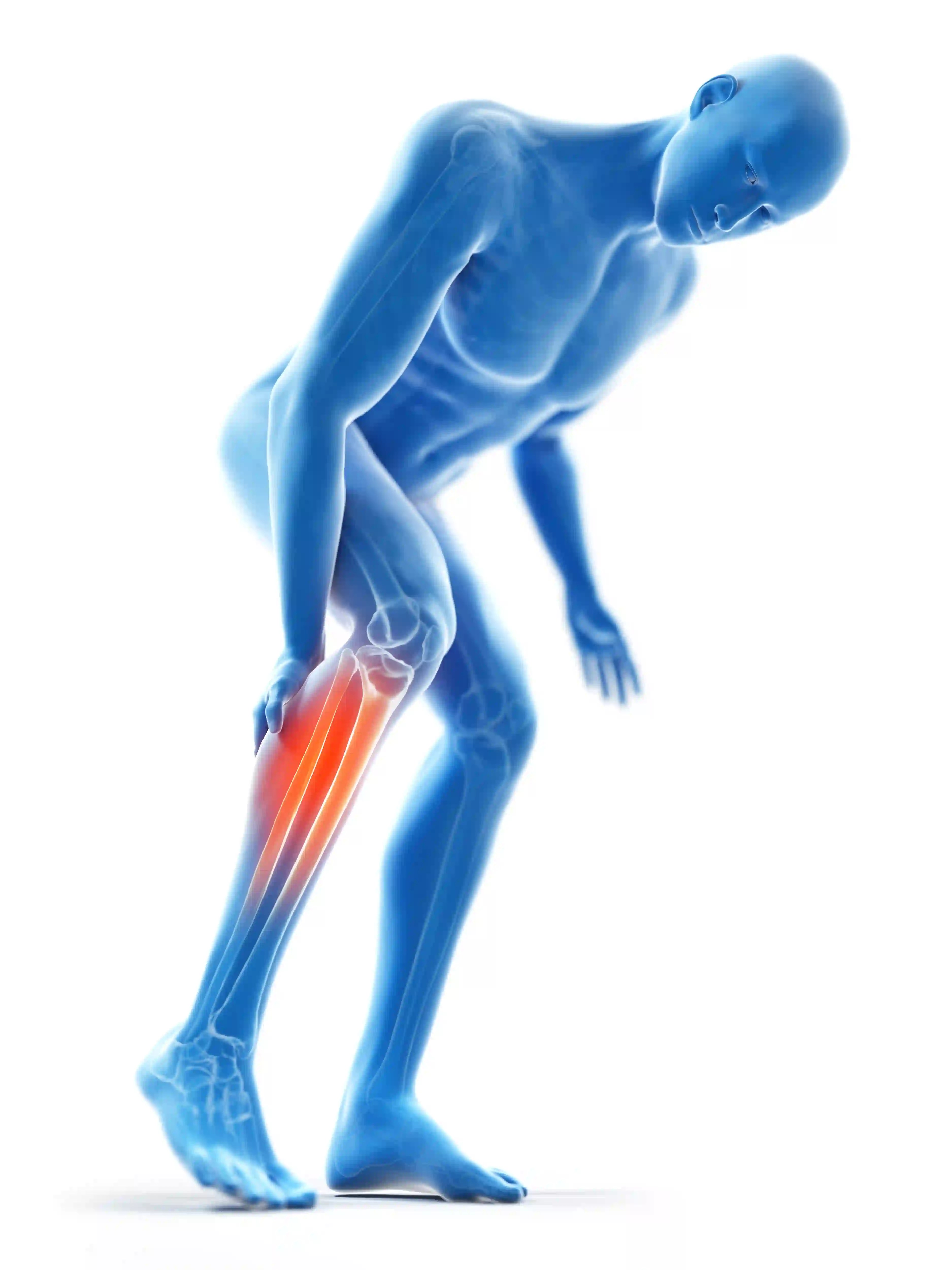 Intermittent Claudication: A Warning Sign of Peripheral Artery Disease ...