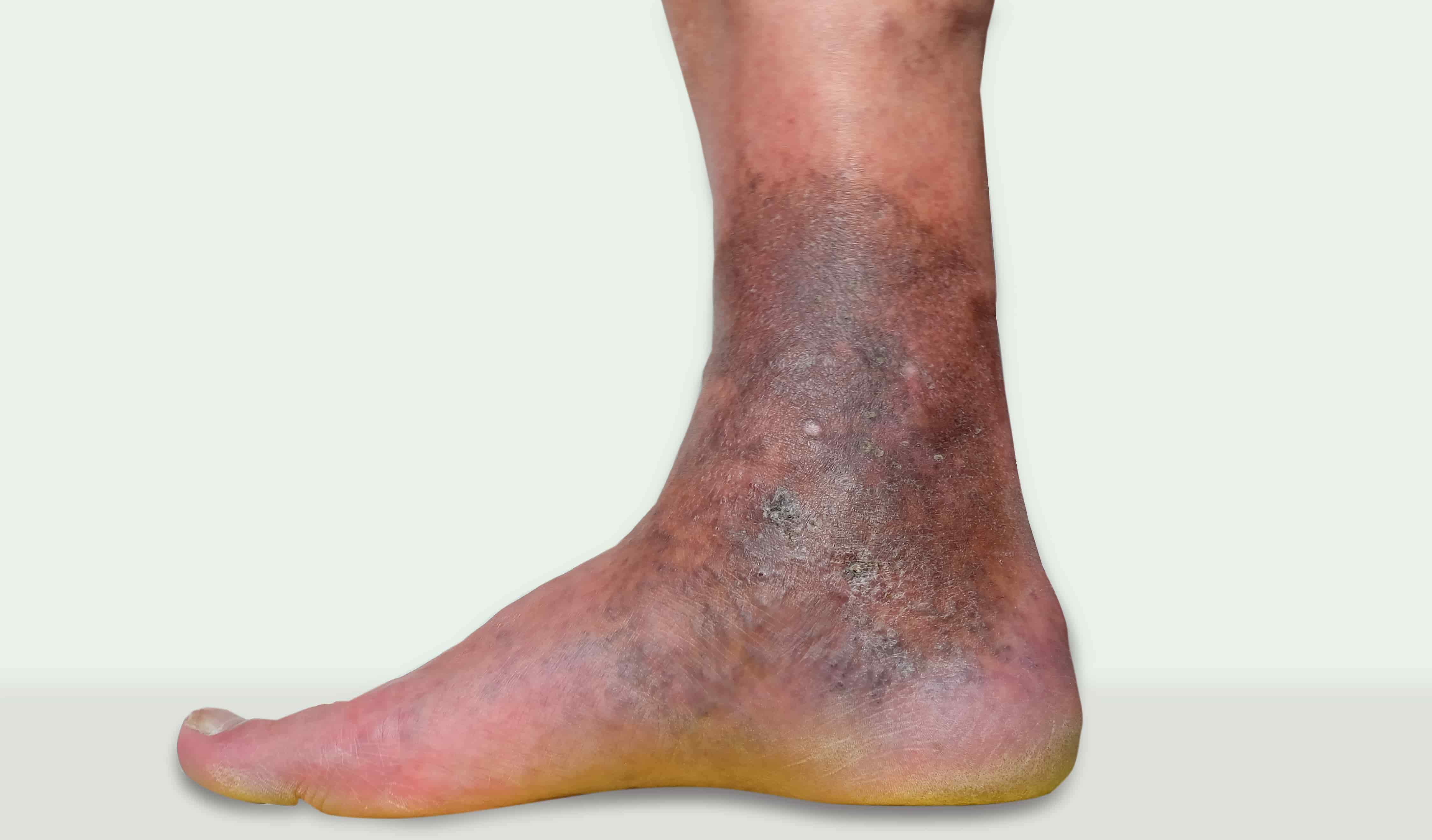 Skin Changes from Varicose Veins and Venous Insufficiency: What to Look ...