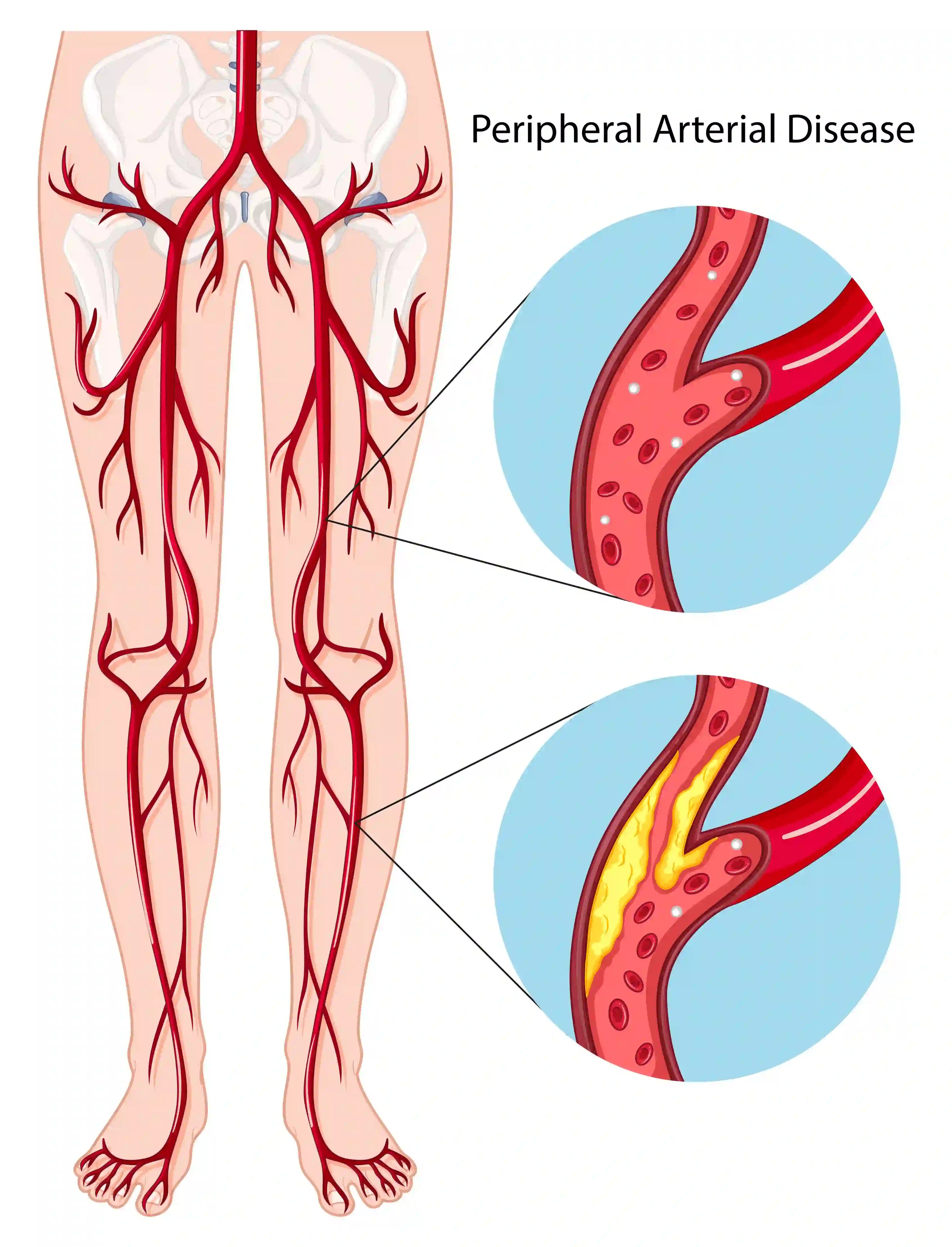 Understanding the Risk Factors of Peripheral Artery Disease (PAD ...